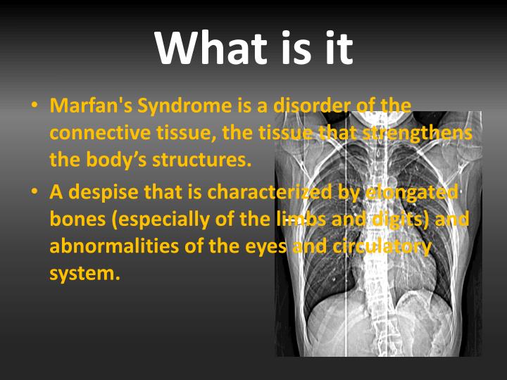 PPT - Marfan’s Syndrome PowerPoint Presentation - ID:1867788