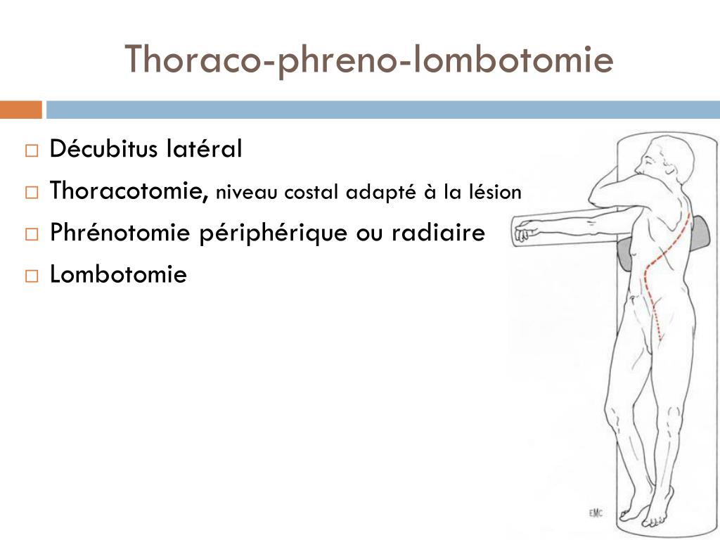 PPT - VOIES D’ABORD EXTRAPÉRITONÉALES DE L’AORTE ABDOMINALE PowerPoint ...