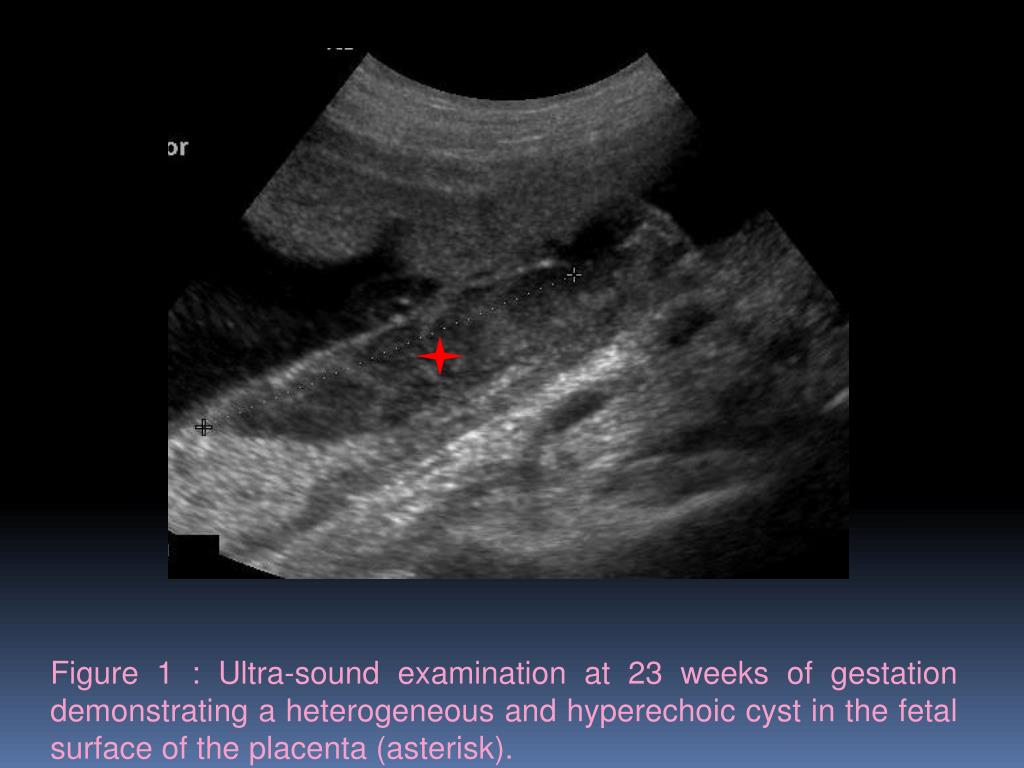 PPT - PRENATAL DIAGNOSIS OF A LARGE PLACENTAL CYST WITH INTRACYSTIC ...