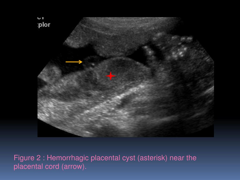 PPT - PRENATAL DIAGNOSIS OF A LARGE PLACENTAL CYST WITH INTRACYSTIC ...