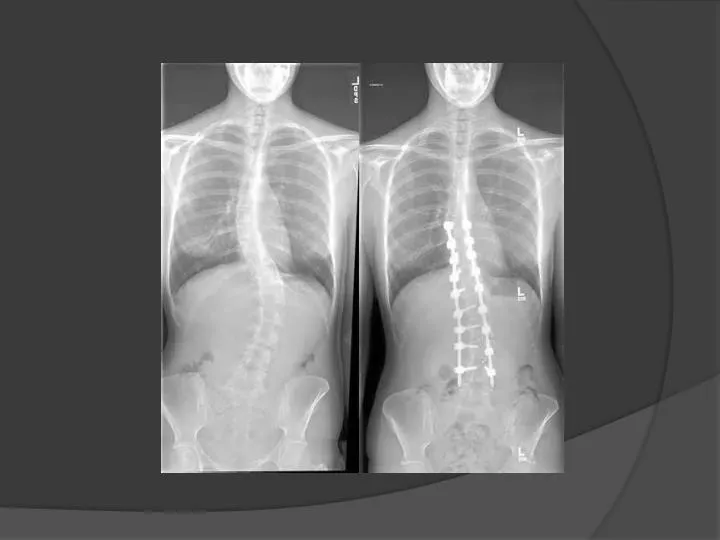 PPT - Scoliosis- explained PowerPoint Presentation, free download - ID ...