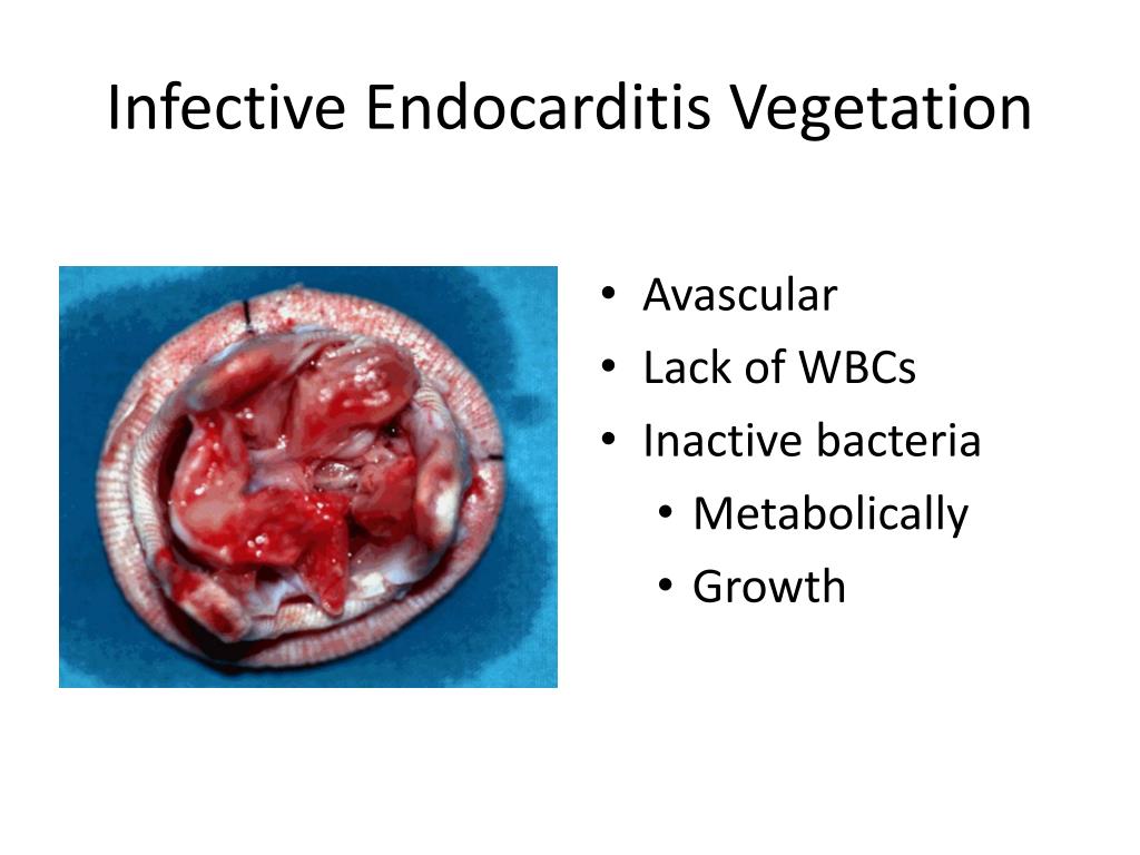 PPT - Treatment of Infective Carditis and Rheumatic Heart Disease ...