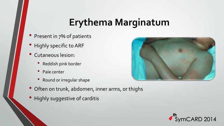 PPT - Acute Rheumatic Fever: Diagnostic and Management PowerPoint ...