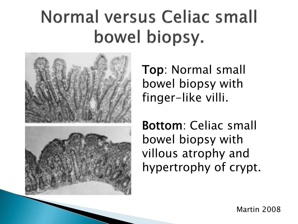 PPT - Celiac disease: No cake for you! PowerPoint Presentation, free ...