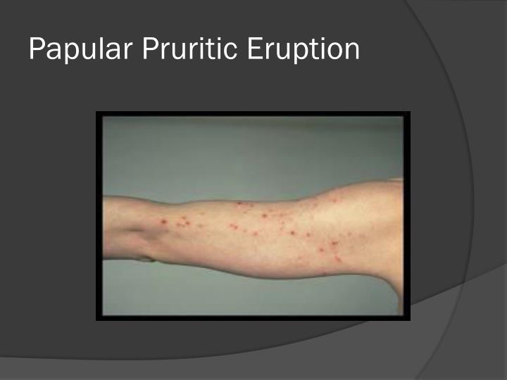 PPT - Early Signs and Symptoms to Suspect HIV PowerPoint Presentation ...