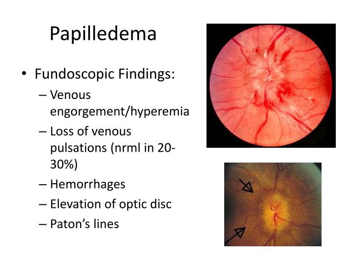 PPT - Stanford Medicine 25 Fundoscopy PowerPoint Presentation - ID:1871147
