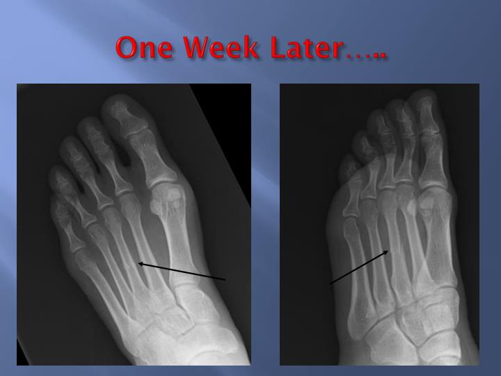 PPT - Pathomechanics of Bone PowerPoint Presentation - ID:1872411