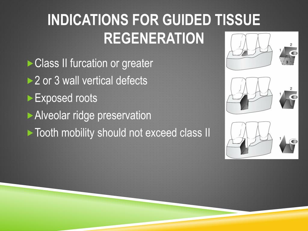 PPT - Guided Tissue Regeneration PowerPoint Presentation, free download ... PPT - Guided Tissue Regeneration PowerPoint Presentation, free download ...