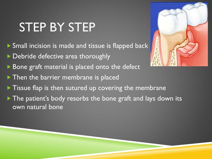 PPT - Guided Tissue Regeneration PowerPoint Presentation - ID:1872423
