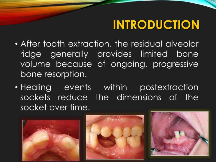 Ppt Socket Preservation Procedure After Tooth Extraction Powerpoint