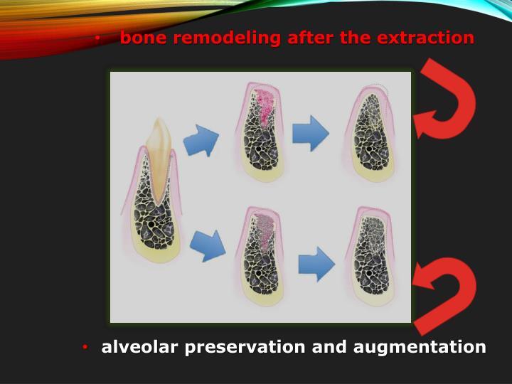 PPT - SOCKET PRESERVATION PROCEDURE AFTER TOOTH EXTRACTION PowerPoint ...