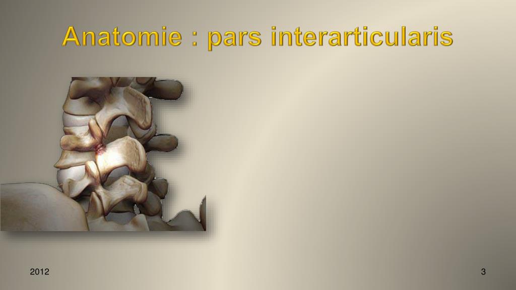 PPT - Spondylolisthésis Diagnostic et traitement PowerPoint ...