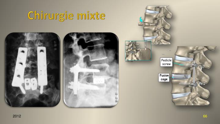 PPT - Spondylolisthésis Diagnostic et traitement PowerPoint ...