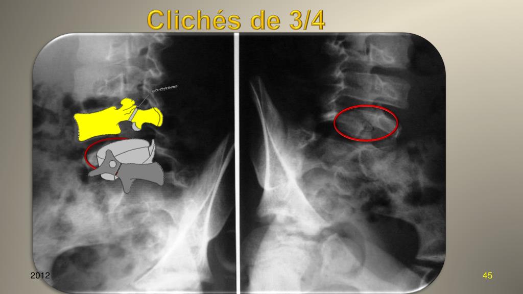 PPT - Spondylolisthésis Diagnostic et traitement PowerPoint ...