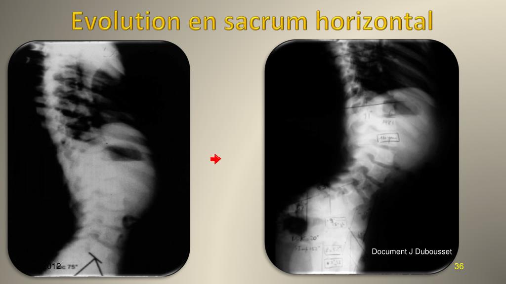PPT - Spondylolisthésis Diagnostic et traitement PowerPoint ...