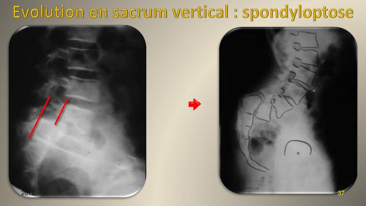 PPT - Spondylolisthésis Diagnostic et traitement PowerPoint ...