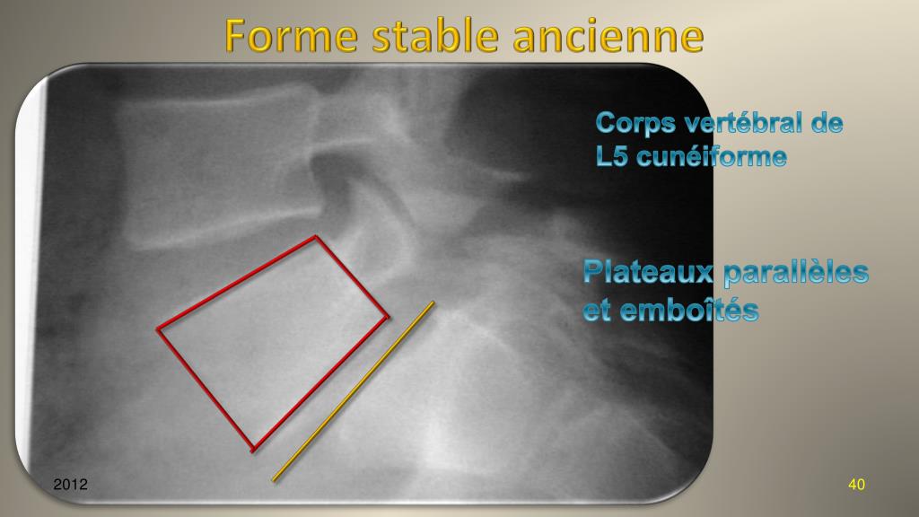 PPT - Spondylolisthésis Diagnostic et traitement PowerPoint ...