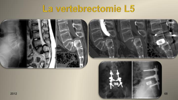 PPT - Spondylolisthésis Diagnostic et traitement PowerPoint ...
