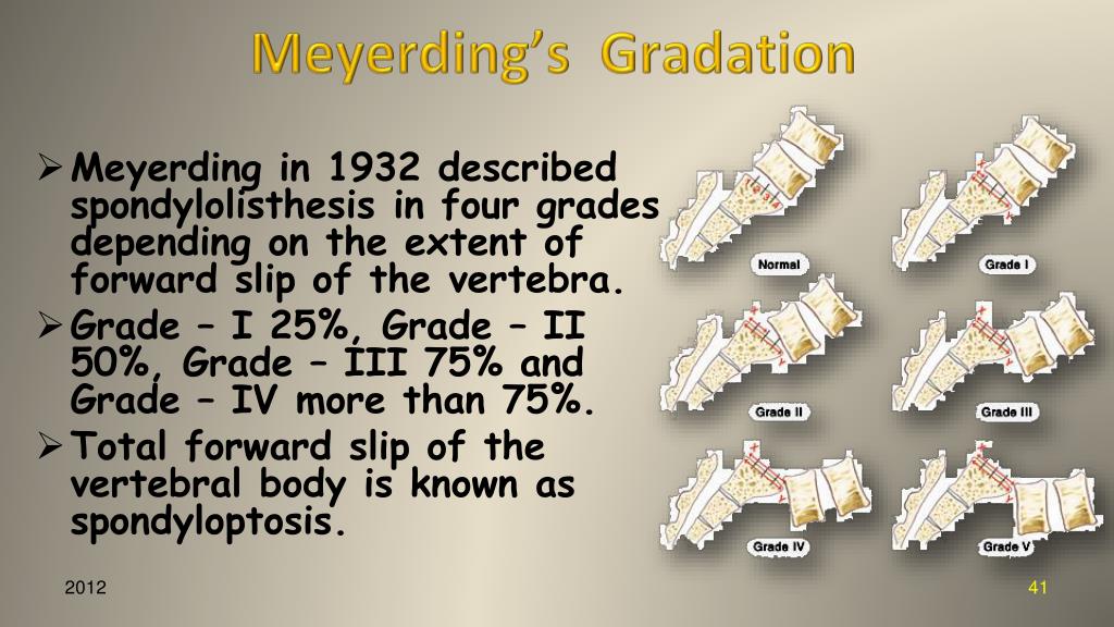 PPT - Spondylolisthésis Diagnostic et traitement PowerPoint ...