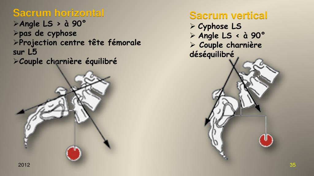 PPT - Spondylolisthésis Diagnostic et traitement PowerPoint ...