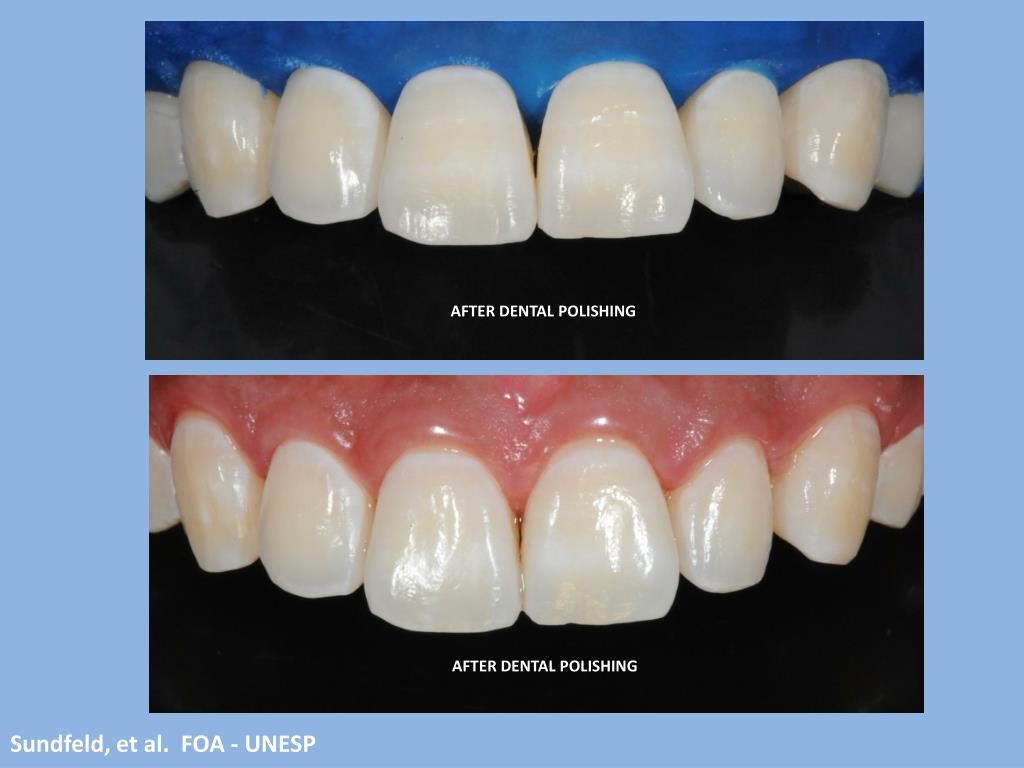 PPT - CLINICAL SEQUENCE OF DENTAL ENAMEL SURFACE TREATMENT AFTER ...