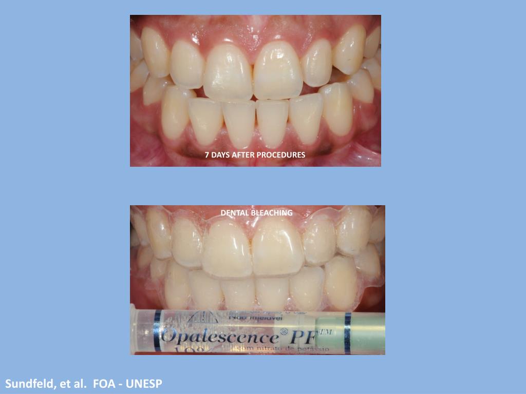 PPT - CLINICAL SEQUENCE OF DENTAL ENAMEL SURFACE TREATMENT AFTER ...