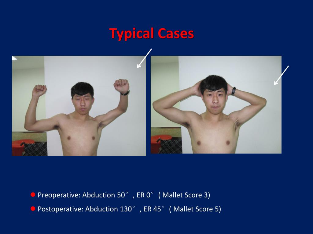 PPT - Gong Xu , Lu Lai Jin, Cui Jian Li, Sun Ru Tao Department of Hand ...