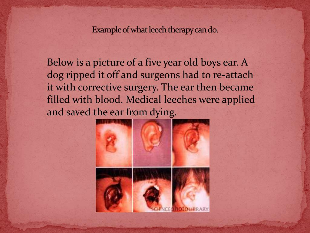 PPT - Medicinal Leeches: Nature’s Finest Surgical Tool From the Swamps ...