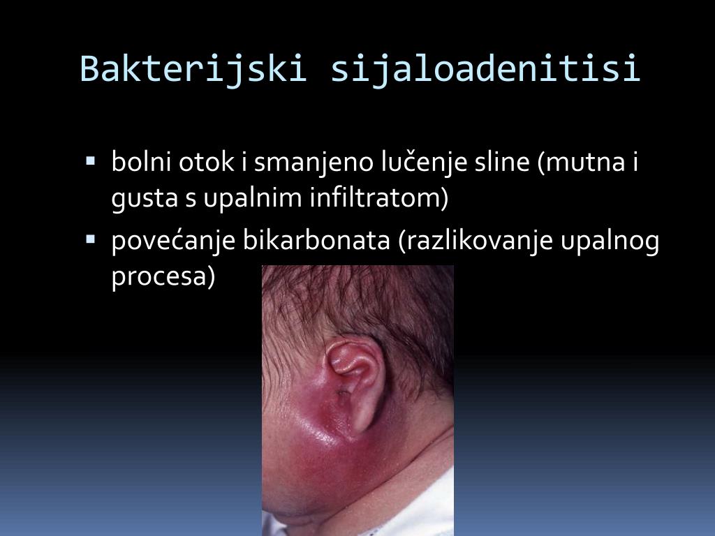 PPT - Bolesti žlijezda slinovnica PowerPoint Presentation, free ...