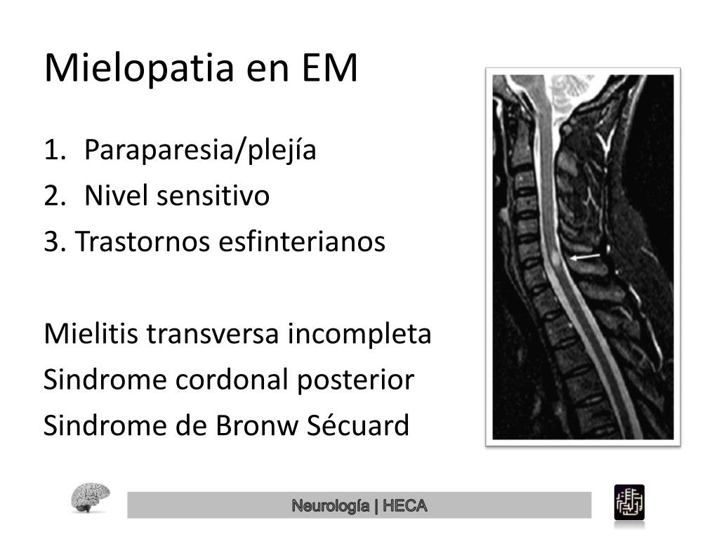PPT - ESCLEROSIS MÚLTIPLE Enfermedades Desmielinizantes PowerPoint ...