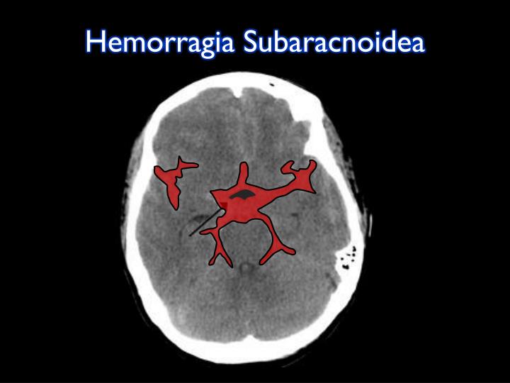 Hemorragia Subaracnoidea Hemorragia Subaracnoidea Cisternas Y Cisuras