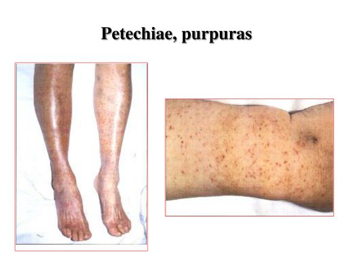 PPT - Blood Coagulation PowerPoint Presentation - ID:1895923