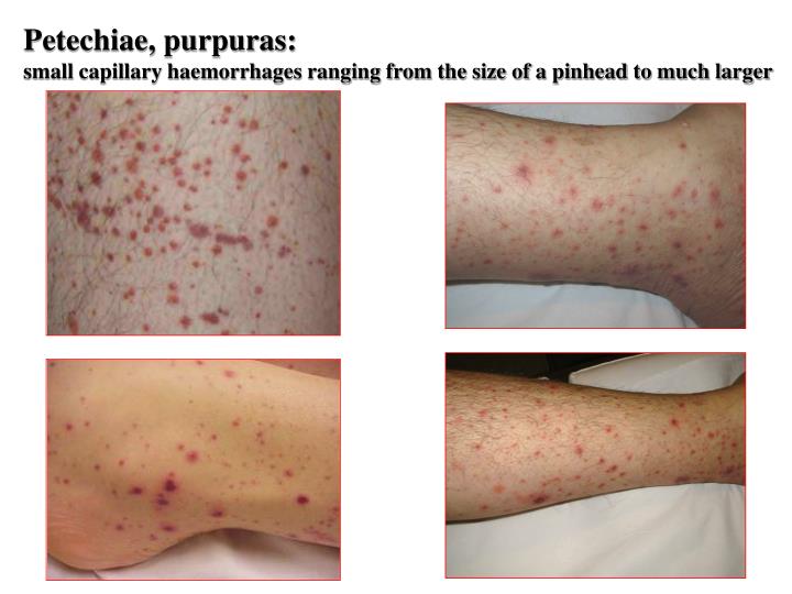 PPT - Blood Coagulation PowerPoint Presentation - ID:1895923