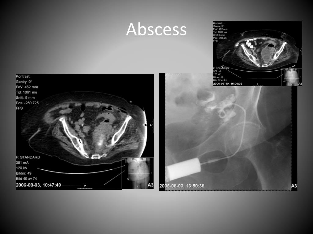 PPT - Diagnosis of diverticulosis and diverticulitis PowerPoint ...