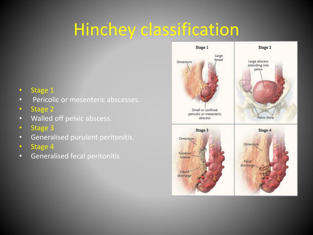 PPT - Diagnosis of diverticulosis and diverticulitis PowerPoint ...