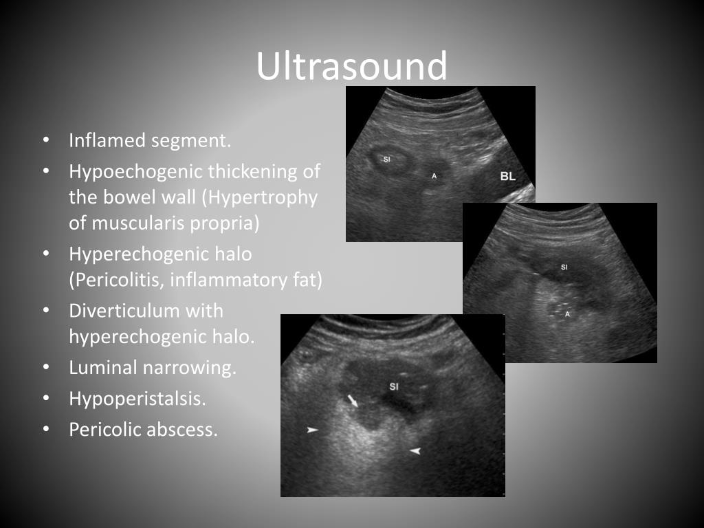 PPT - Diagnosis of diverticulosis and diverticulitis PowerPoint ...