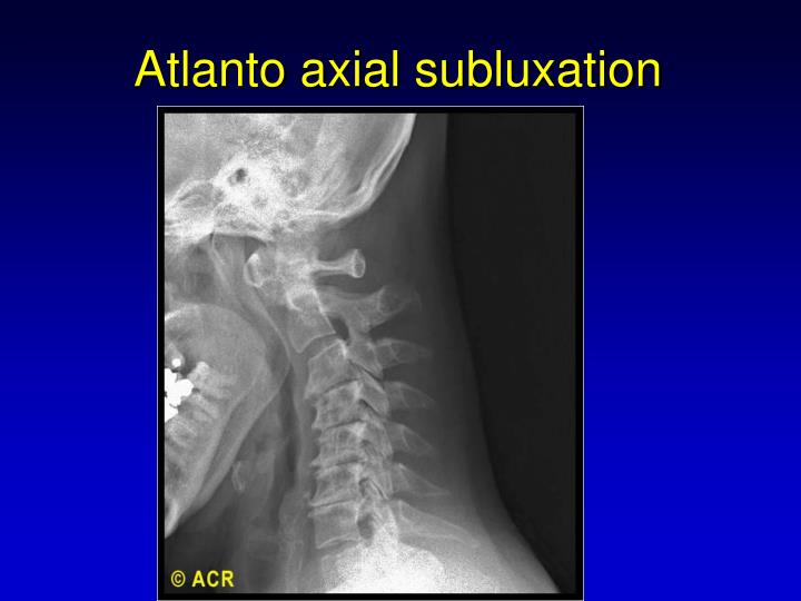Atlanto-axiale Subluxation || Med-koM