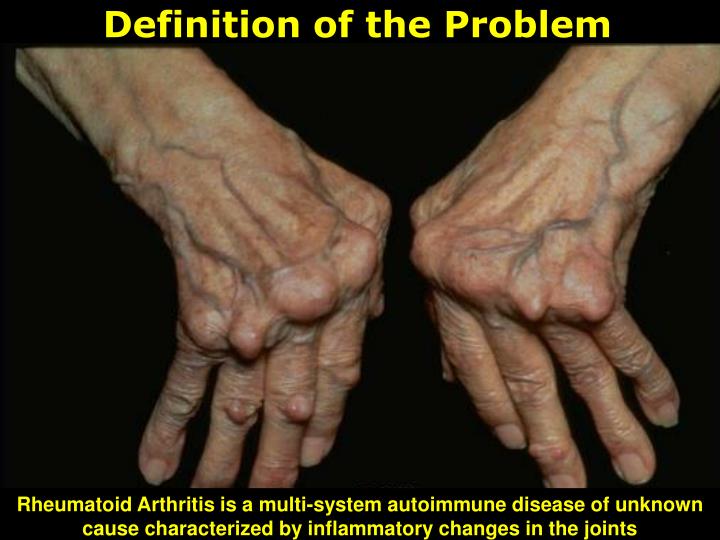 PPT - Rheumatoid Arthritis PowerPoint Presentation - ID:1897898
