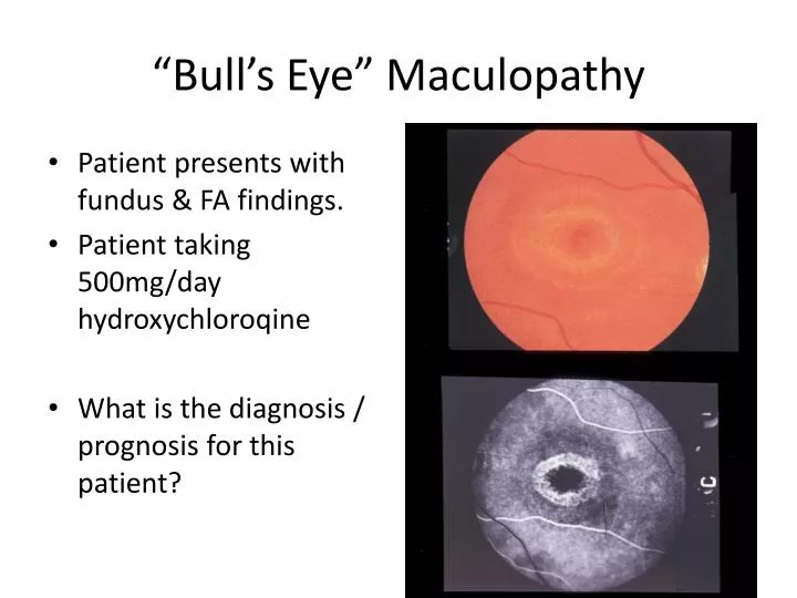 PPT - “Bull’s Eye” Maculopathy PowerPoint Presentation - ID:1898377