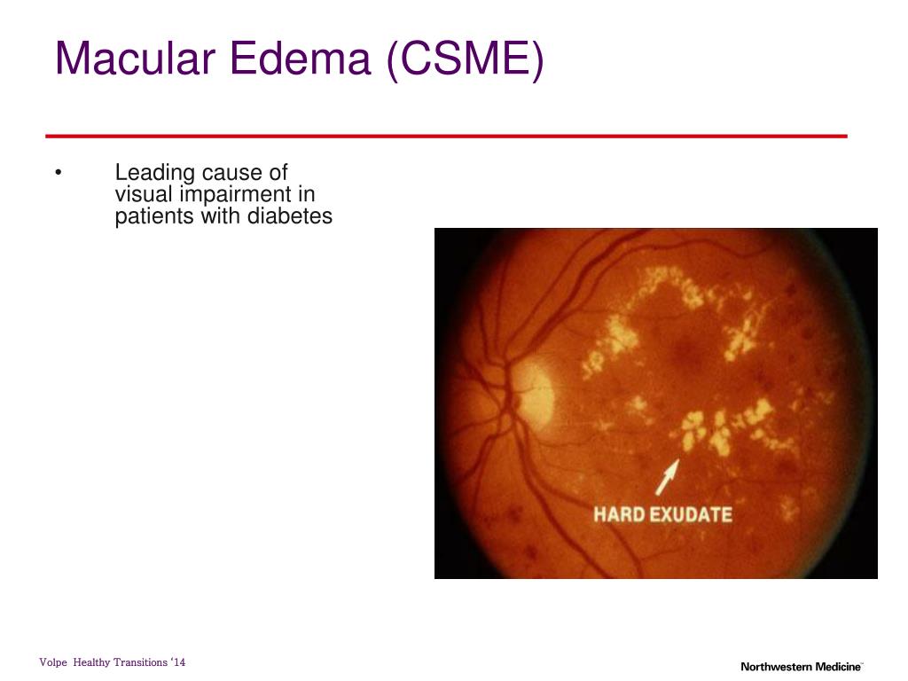 PPT - Nicholas J. Volpe, MD Tarry Professor and Chairman Department of ...