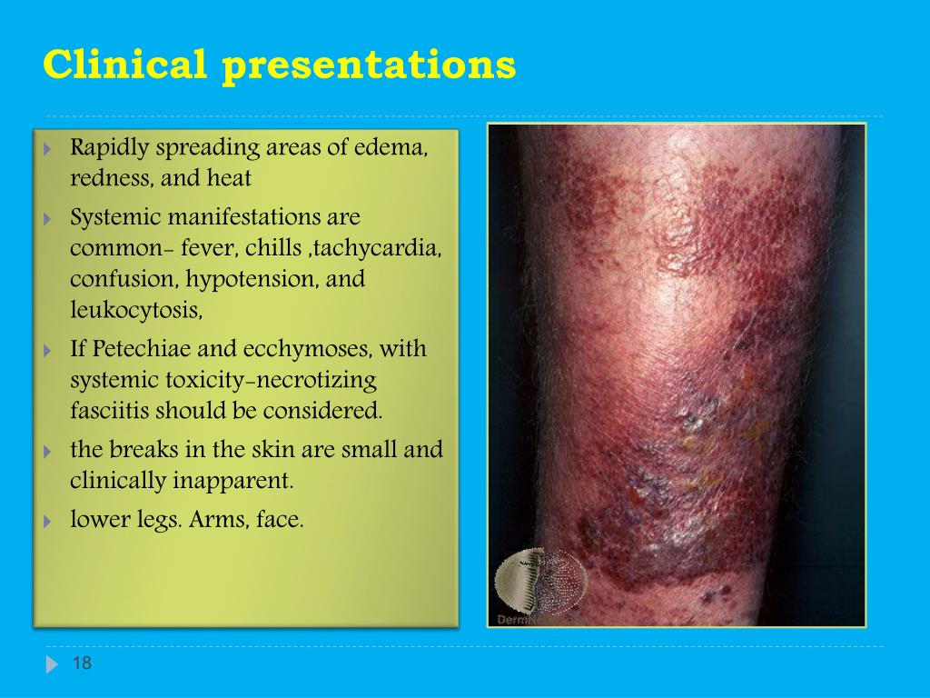 Ppt Skin And Soft Tissue Infections Powerpoint Presentation Free