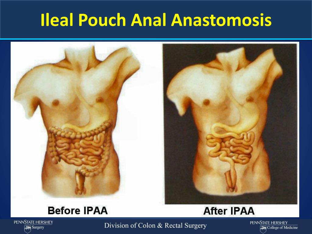 PPT - Genetic Predictors of Quality of Life Post Ileal Pouch Anal ...