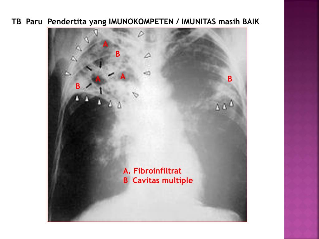 PPT - TB H IV d Arimbi,S p .P ILMU PENYAKIT DALAM FK UWK SURABAYA ...