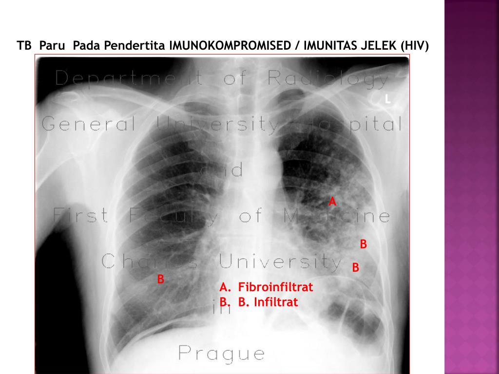 PPT - TB H IV d Arimbi,S p .P ILMU PENYAKIT DALAM FK UWK SURABAYA ...