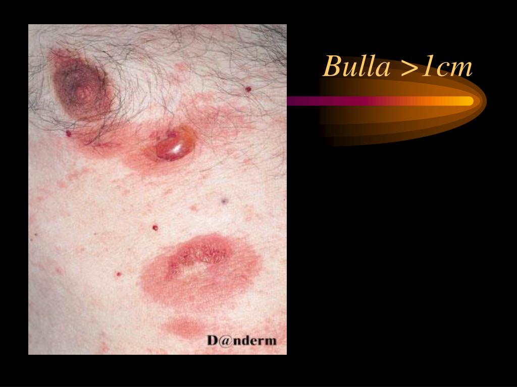 PPT - Top Dermatological Tips on diagnosing skin lesions for busy GPs ...
