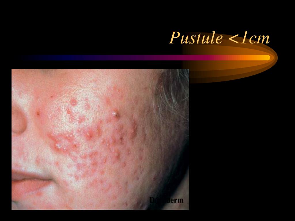 PPT - Top Dermatological Tips on diagnosing skin lesions for busy GPs ...