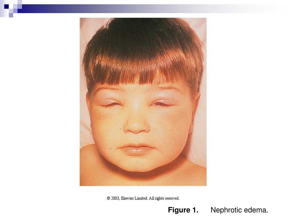 PPT - Nephrotic syndrome Dr.Minoo nephrologist TUMS PowerPoint ...
