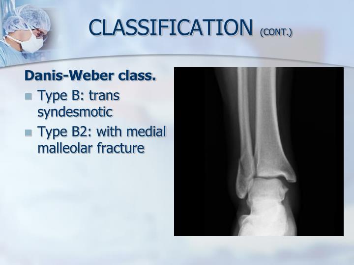 PPT - ANKLE FRACTURE PowerPoint Presentation - ID:1901689