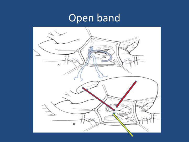 PPT - Tricuspid Valve Disease PowerPoint Presentation - ID:1902037
