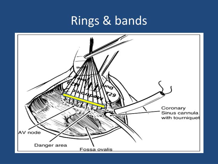 PPT - Tricuspid Valve Disease PowerPoint Presentation - ID:1902037